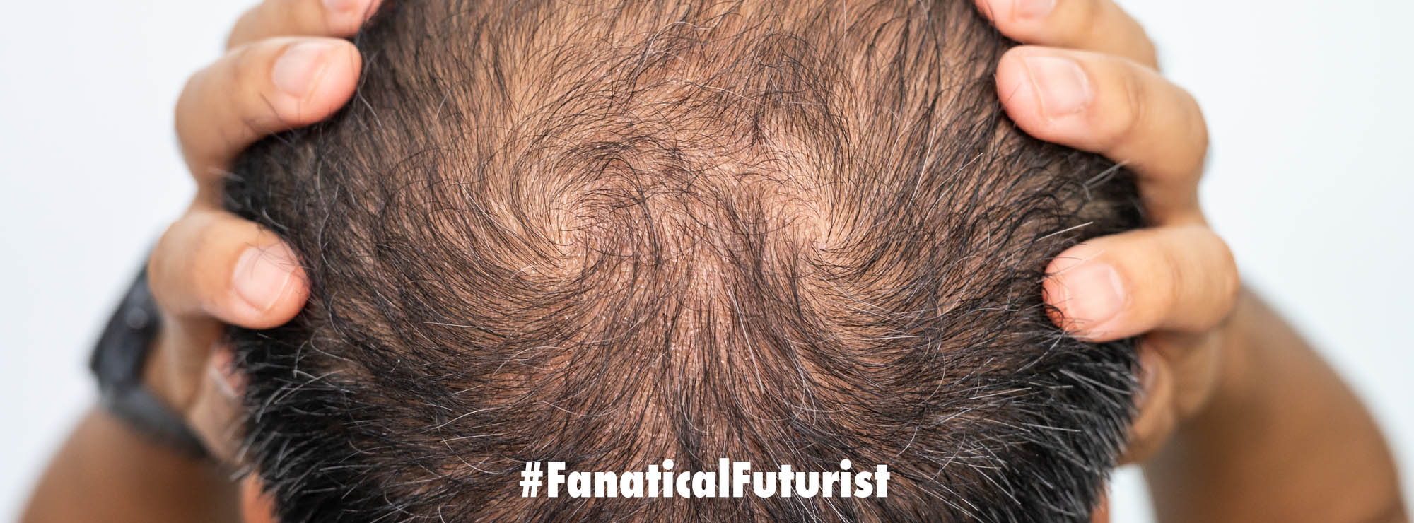 This new Brain Computer Interface fits between the hairs on your head – Matthew Griffin ...